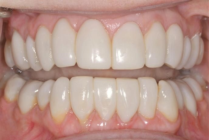 Bioclear Treatments - Elegant Smiles Dental Implant Centre | Dentist in ...