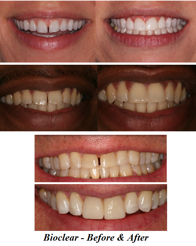 Diastema - Elegant Smiles Dental Implant Centre | Dentist in Heckington ...